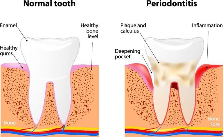 Periodontal disease (Gum Disease): Symptoms, Causes & Treatment ...