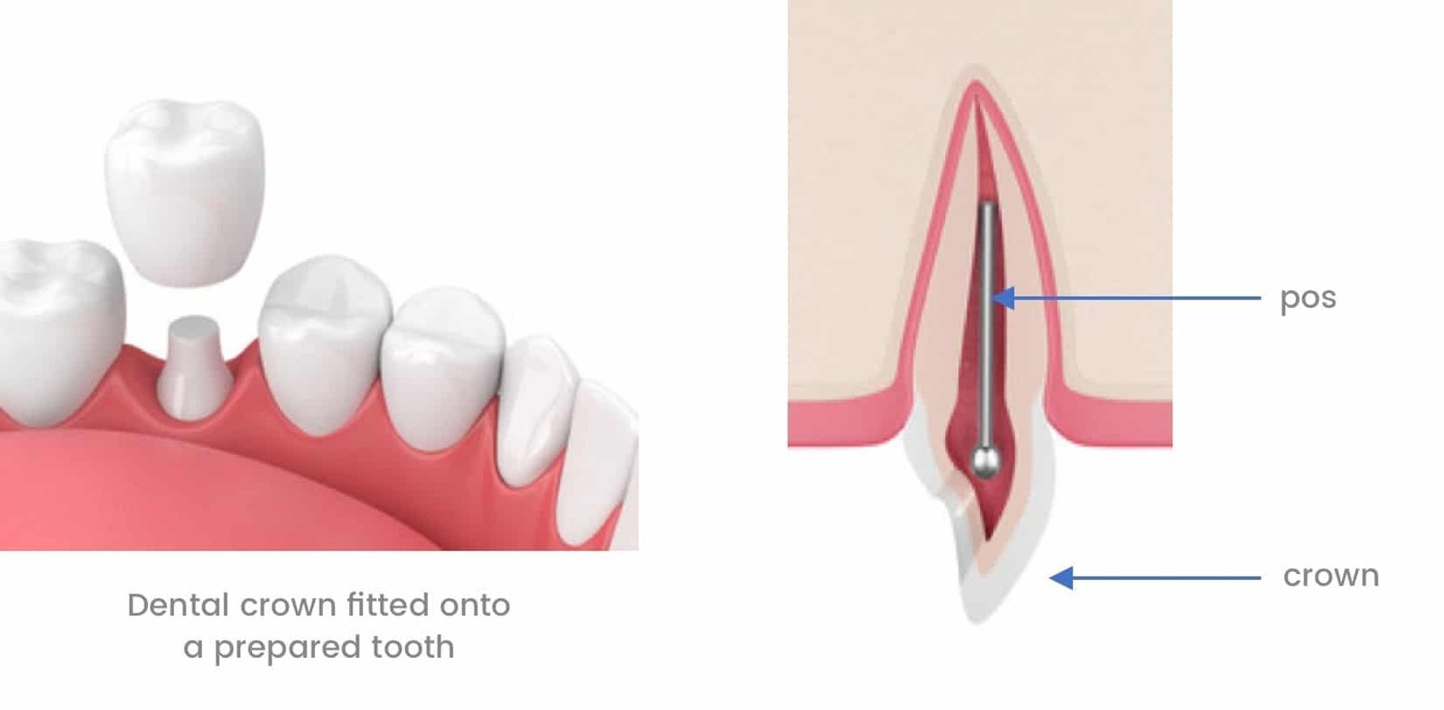 Prosthodontics | Distinguished Smiles